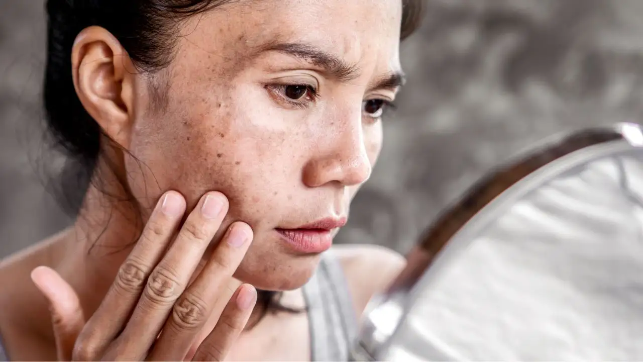 How to Deal with Pimples on Your Lip Line - Dermatocare