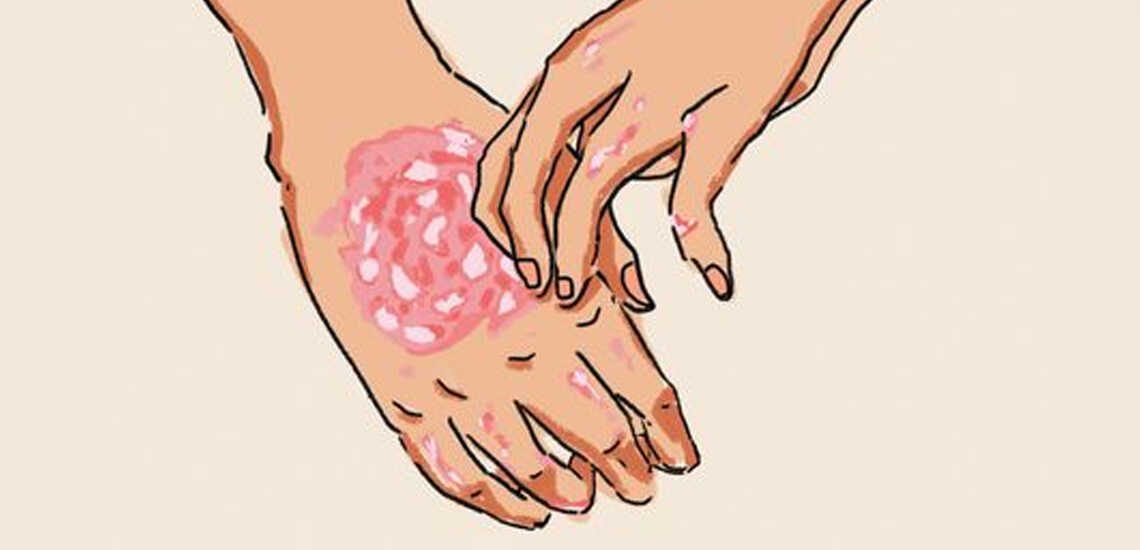 How To Cure Psoriasis Know From A Dermatologist Dermatocare